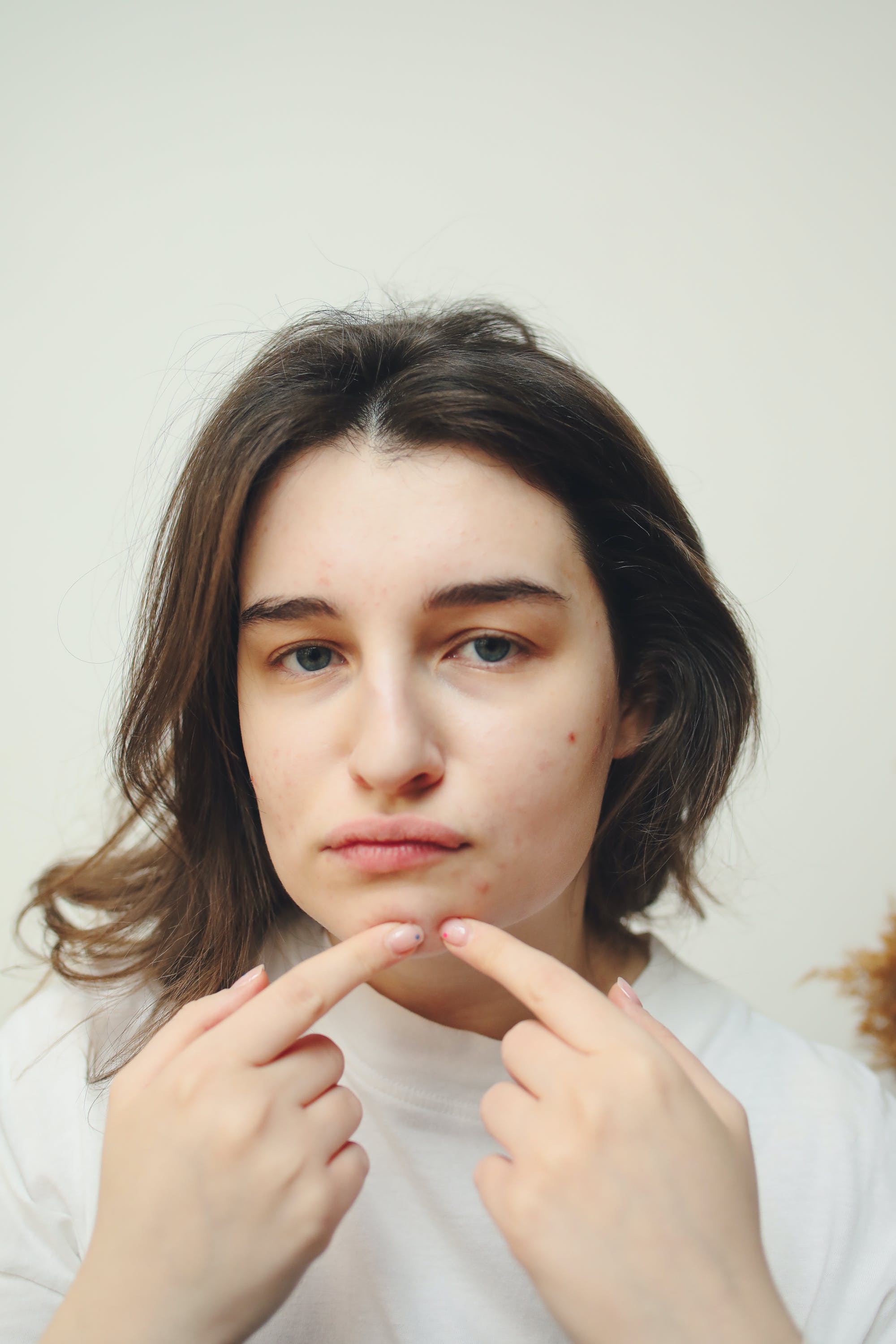 Curare l'Acne Ormonale Senza Pillola: Approcci Naturali e Consigli Pra ...