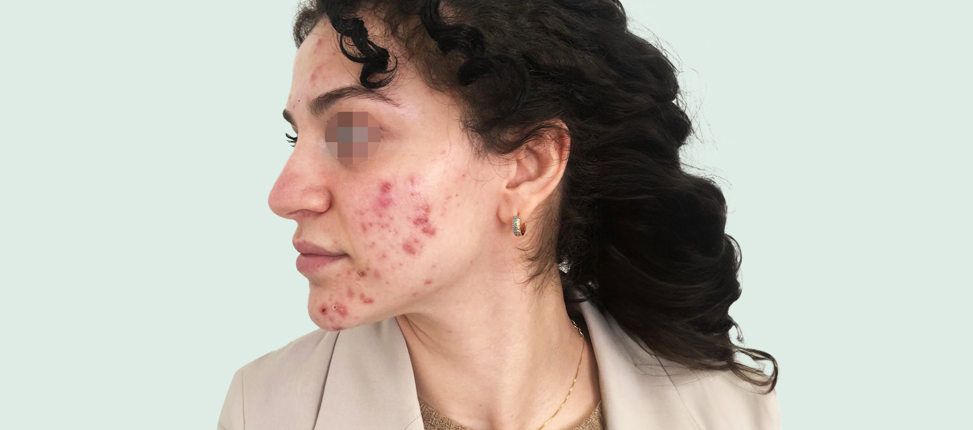 LaMuseLab - Acne and sensitive skin solutions